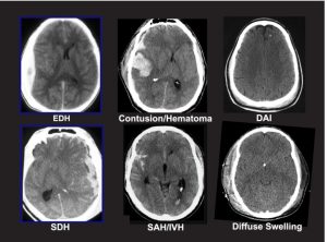 Epidural Hematoma (EDH): Surgery, ICU Care & Prognosis