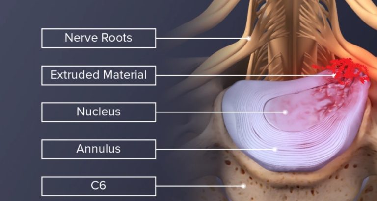 Cervical Disc Herniation & Radiculopathy — Causes and Surgery Guide