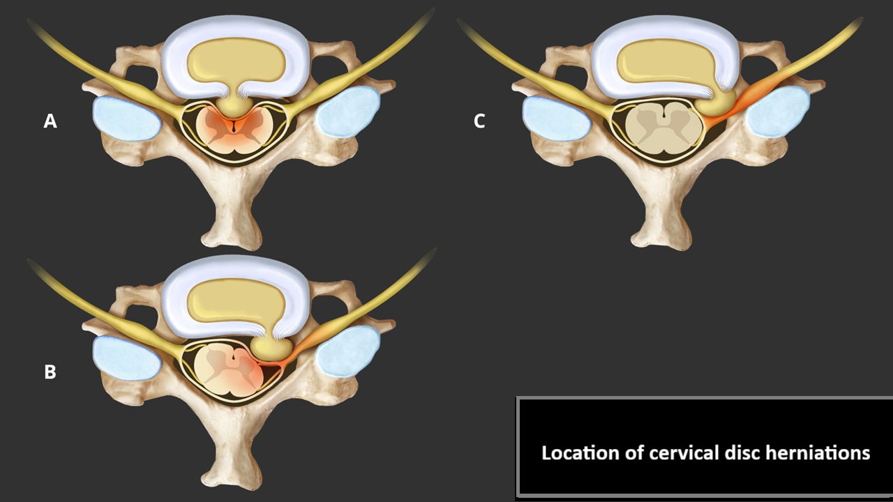 Cervical Disc Herniation & Radiculopathy — Causes and Surgery Guide