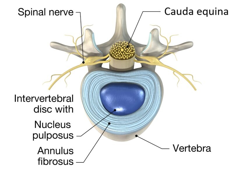 Lumbar Disc Herniation & Sciatica: Diagnosis, Treatment