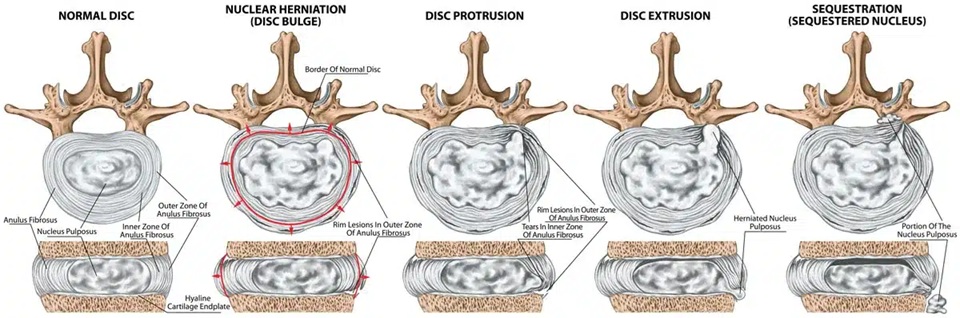 Lumbar Disc Herniation & Sciatica: Diagnosis, Treatment