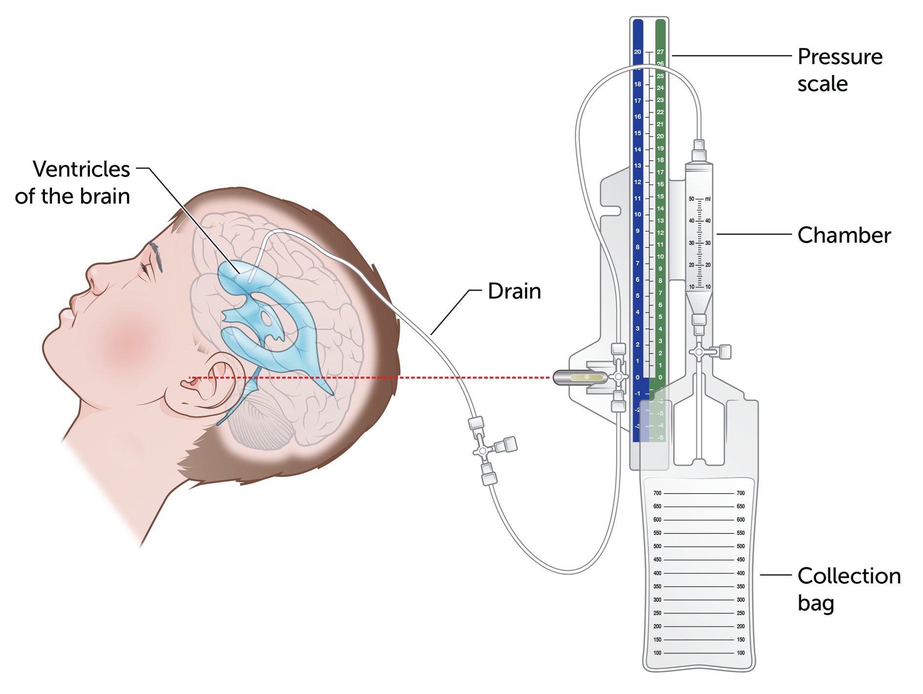 Intracerebral Hematoma — When to Operate? Prognosis