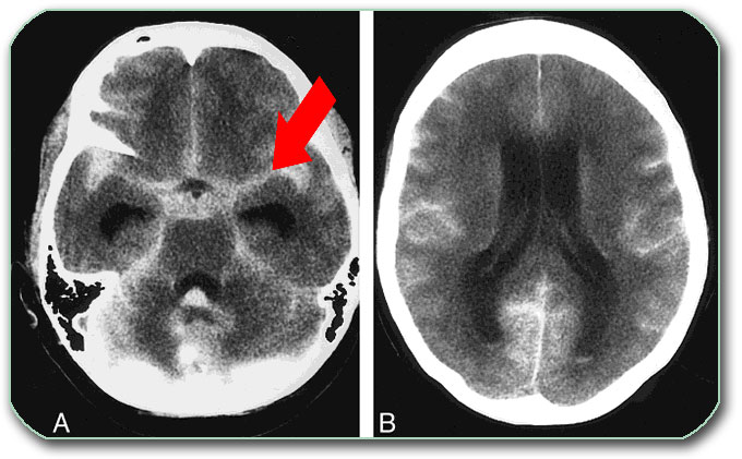 Subarachnoid Space — Simply Explained for Patients