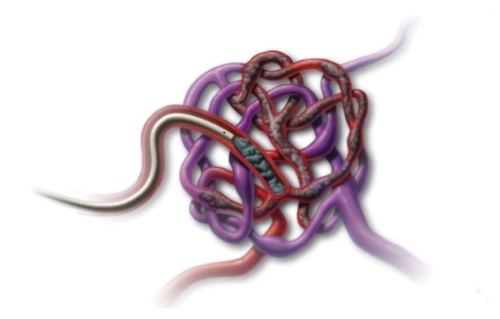 Brain AVM — Risk, Diagnosis & Treatment