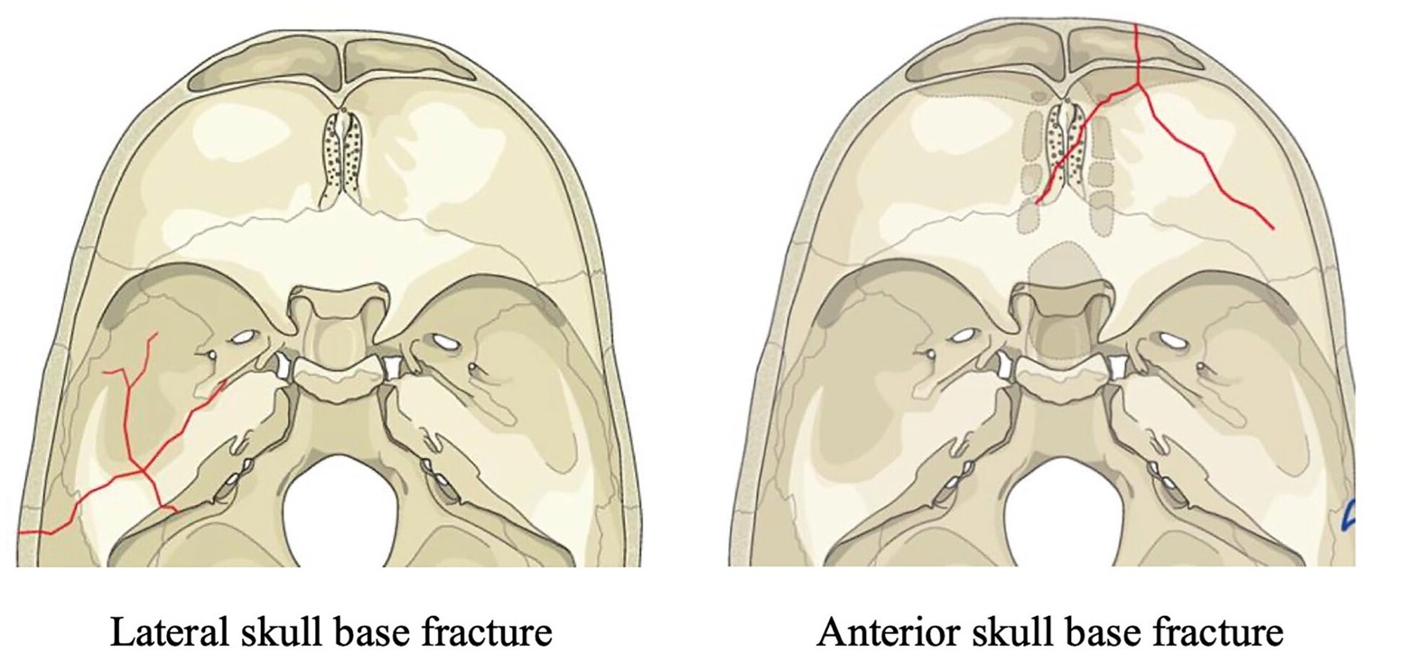 Skull Fractures Explained — CT Findings, CSF Leak & Surgery