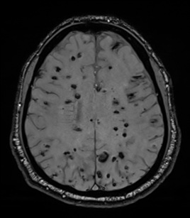 Cavernoma (Cerebral & Spinal): Symptoms, MRI & Treatment